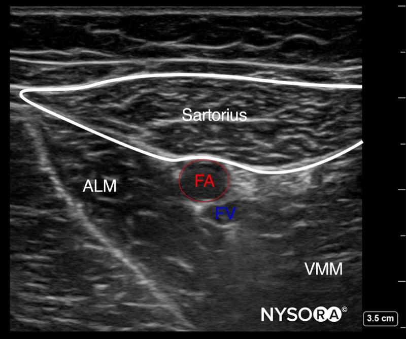 FA, femoral artery; FV, femoral vein; ALM, adductor longus muscle; VMM ...