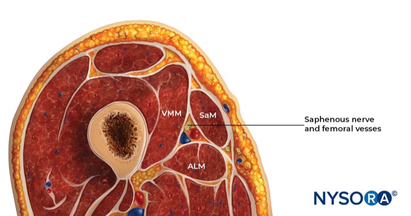 Anatomy of the adductor canal: Sartorius muscle (SaM), vastus medialis ...